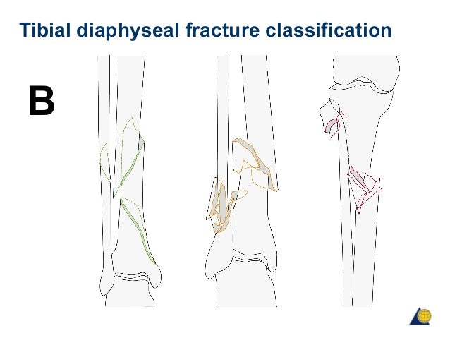 Diaphyseal (tibia and femur) fractures
