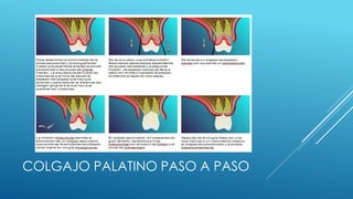 Incisiones y colgajos | PDF