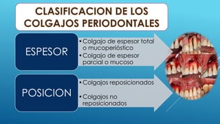 Incisiones y colgajos | PDF