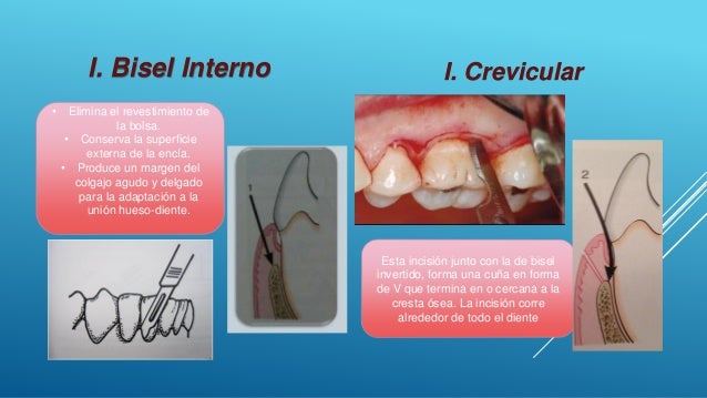 Incisiones y colgajos