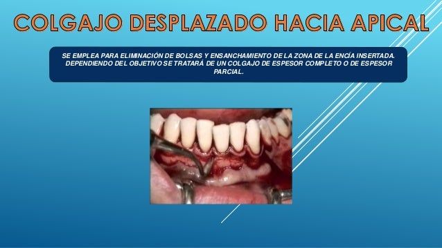 Incisiones y colgajos
