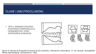 Clasificacion de las Maloclusiones | PPTX