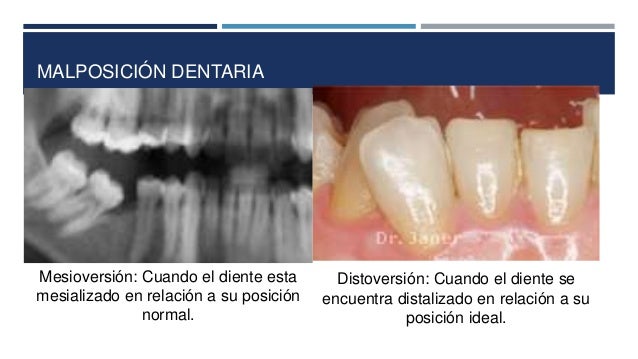 Clasificacion de las Maloclusiones