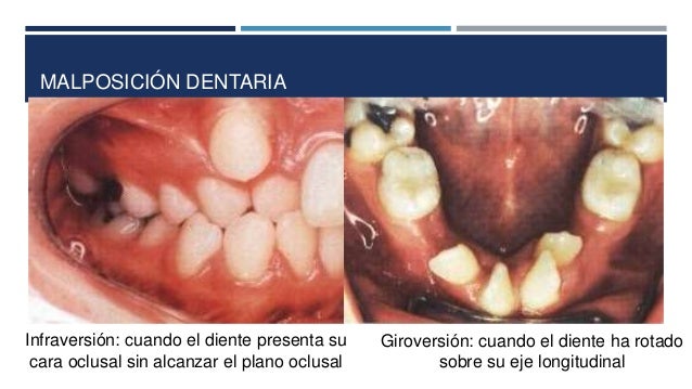 Clasificacion de las Maloclusiones