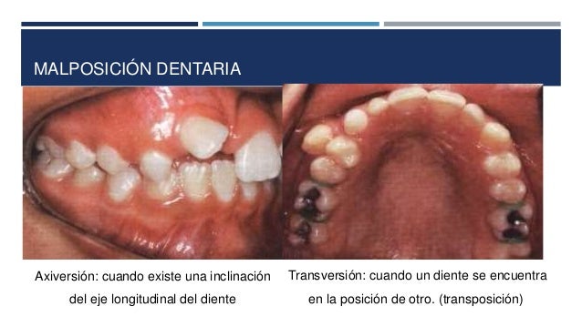 Clasificacion de las Maloclusiones