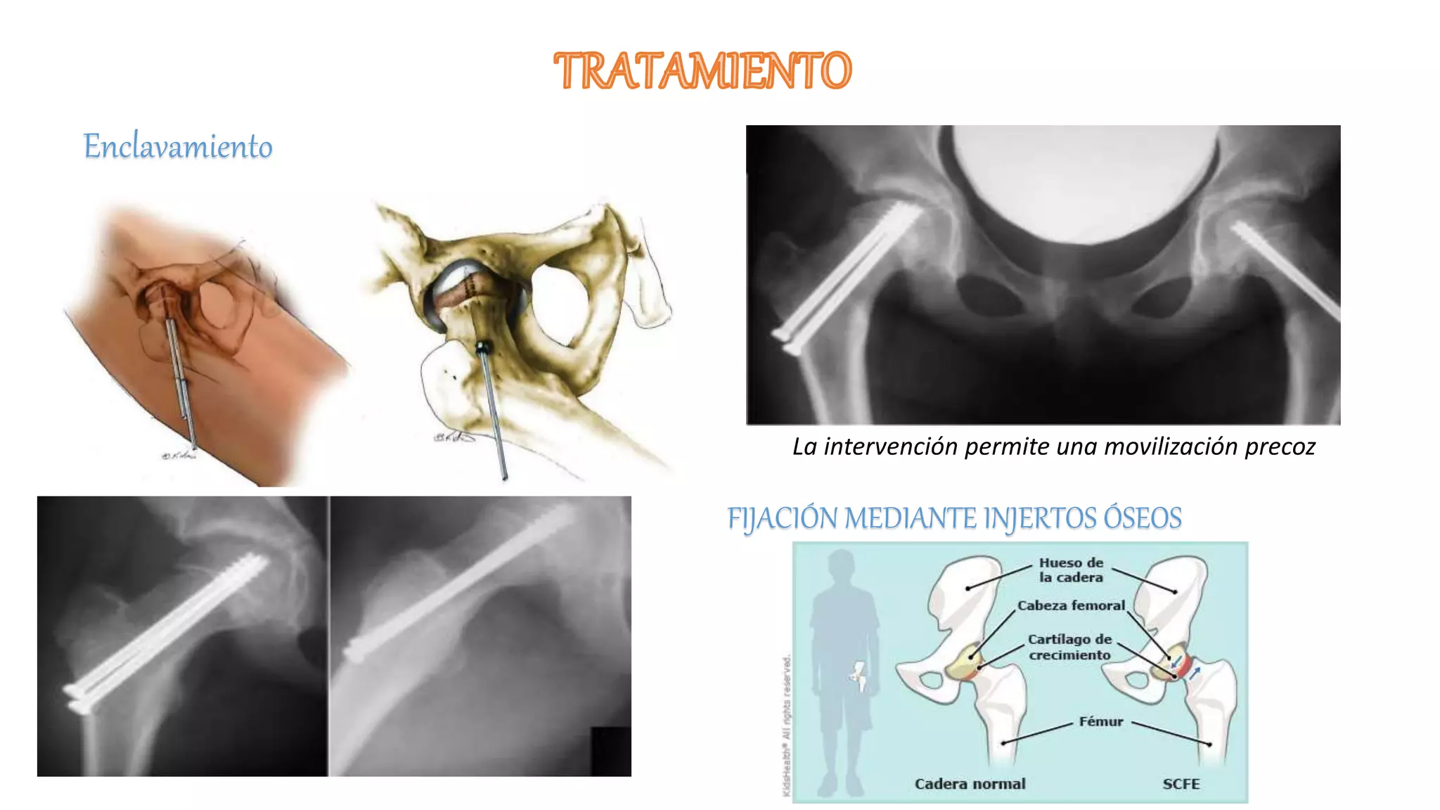 Epifisiolisis femoral | PPTX