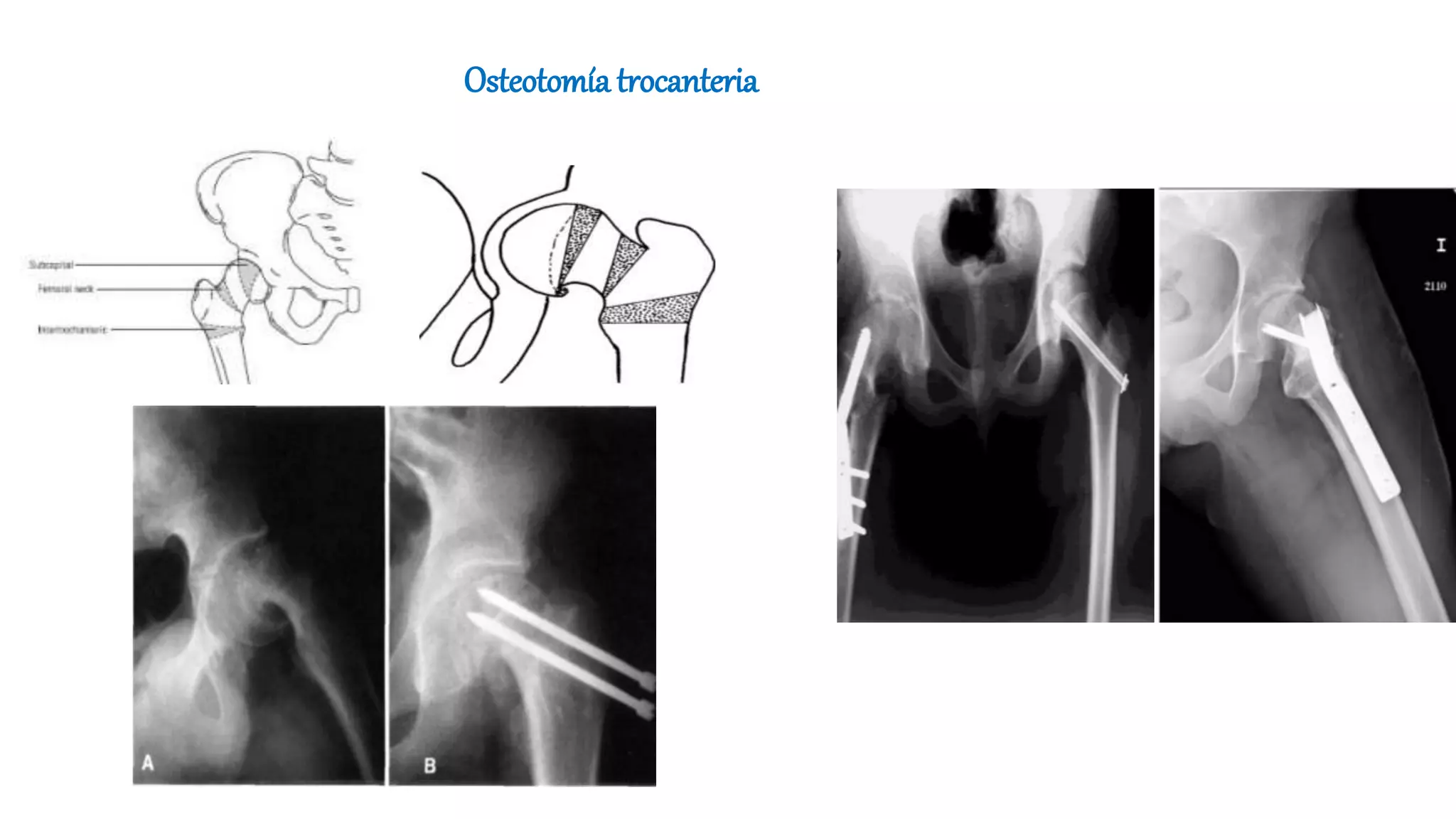 Epifisiolisis femoral | PPTX