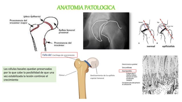 Epifisiolisis femoral | PPTX