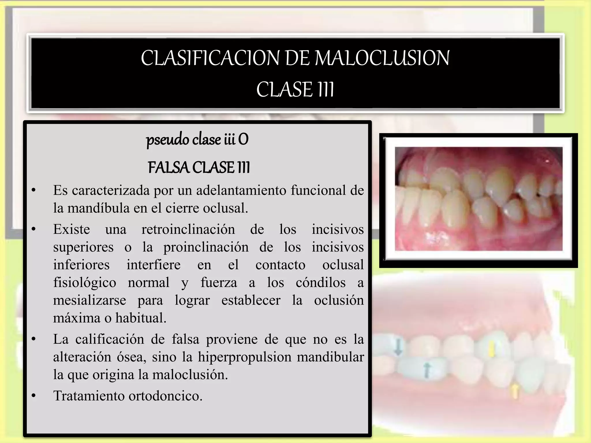 tipos de maloclusion clase I, II, III | PPTX | Oral care | Personal Care