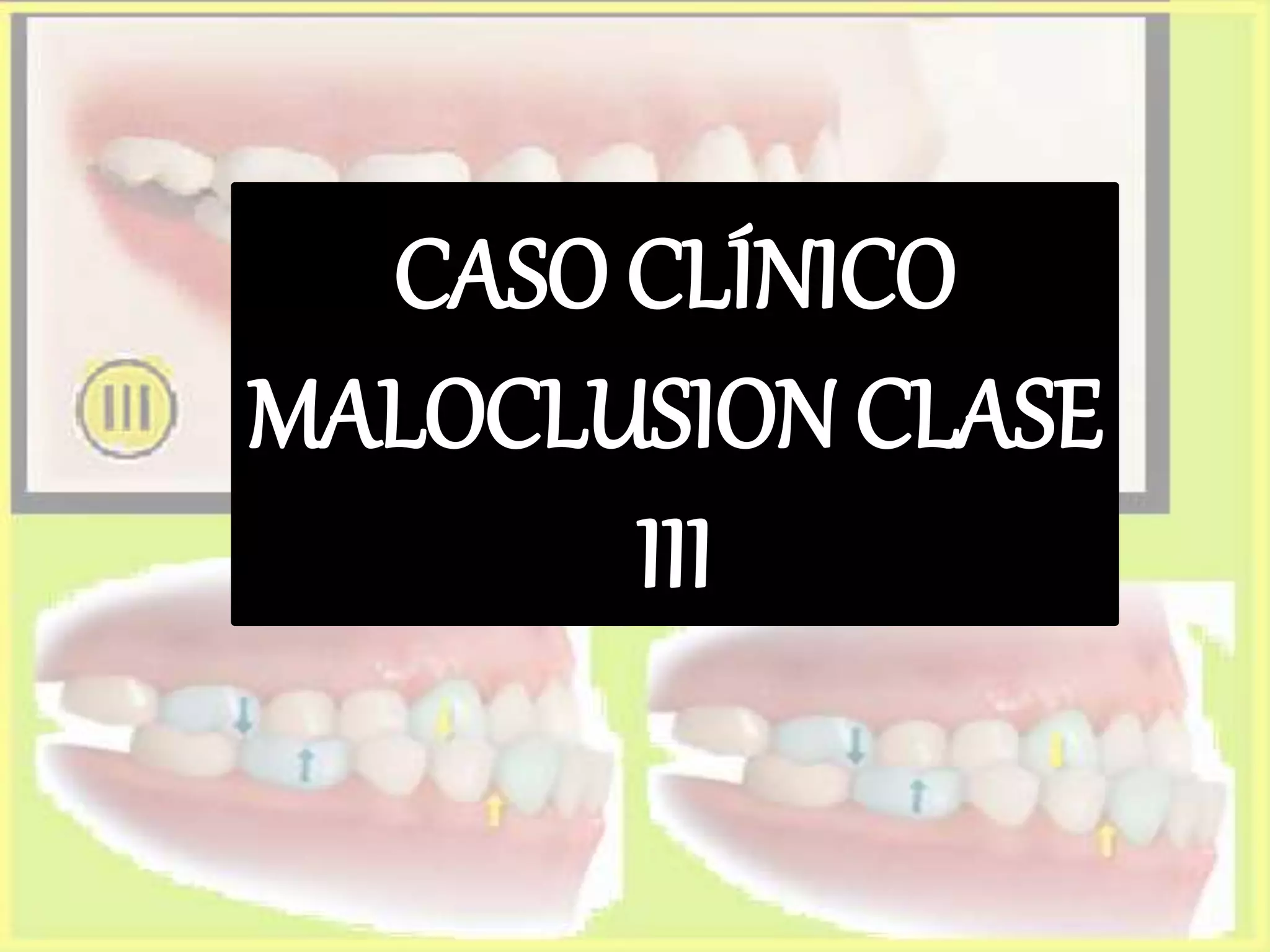 tipos de maloclusion clase I, II, III | PPTX | Oral care | Personal Care