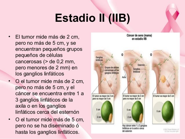 Diapositiva - Cancer de mama