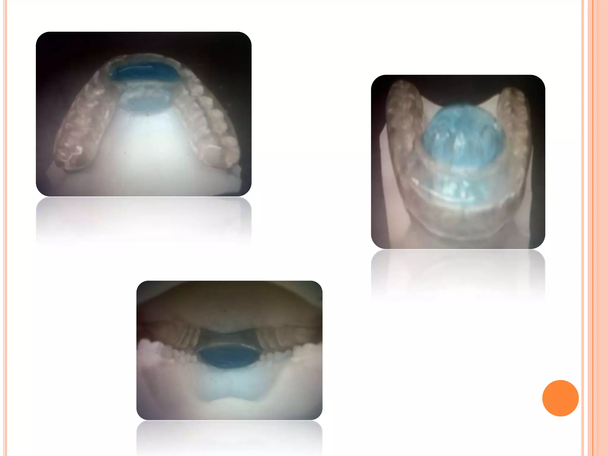 Diapositiva de las férulas oclusales | PPTX | Dental Health | Diseases ...
