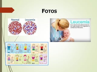 Leucemia | PPTX