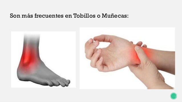 Fracturas y Torceduras.