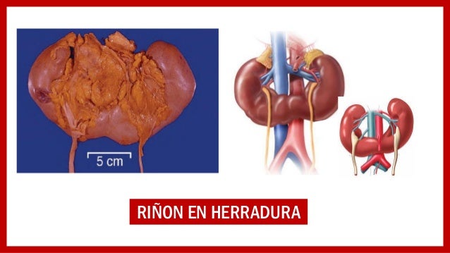 PATOLOGÍA DEL RIÑÓN