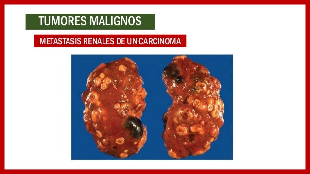 PATOLOGÍA DEL RIÑÓN