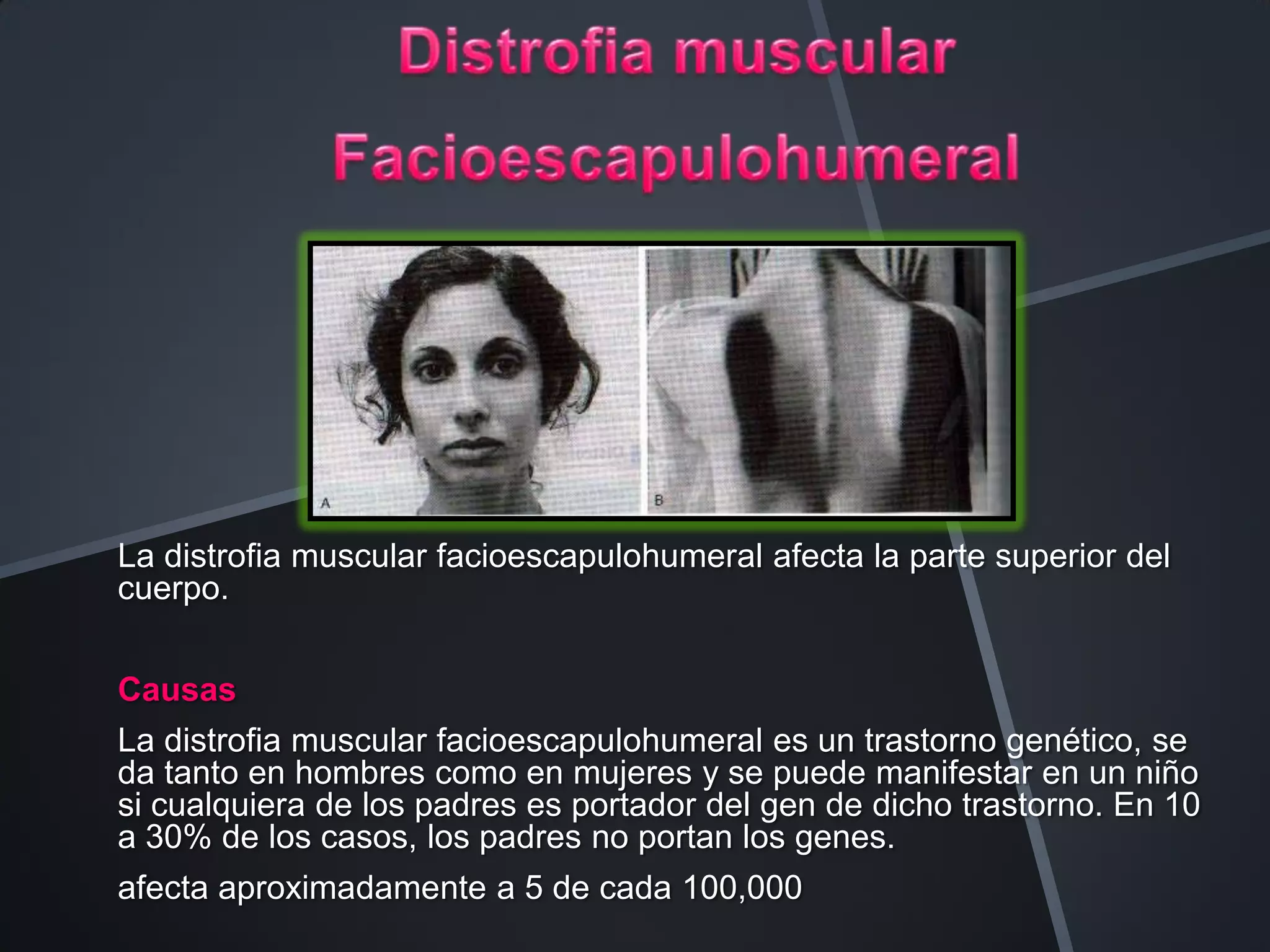 distrofia muscular | PPT