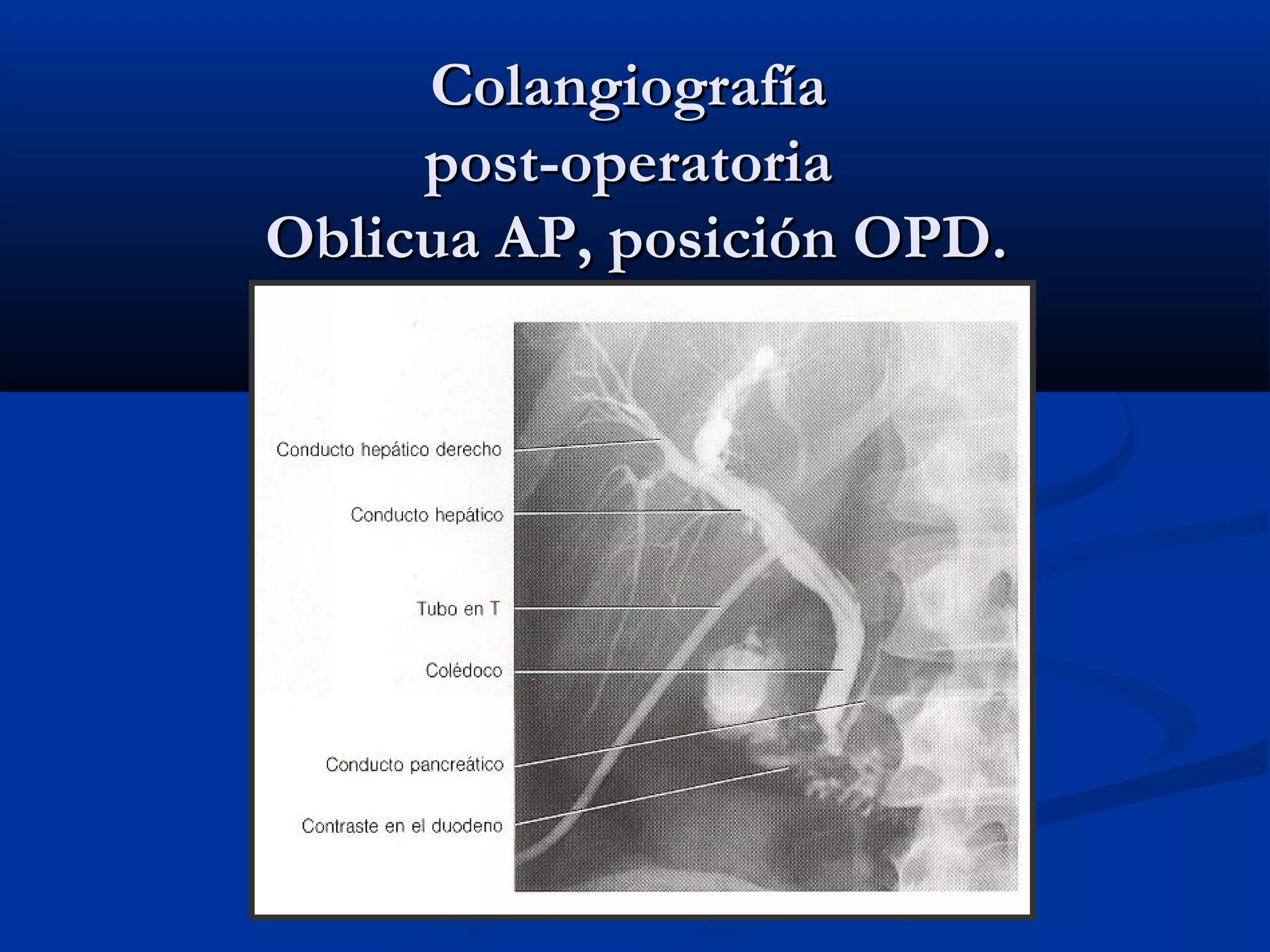 colangiografia | PPT