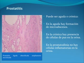 Diapositivas patologia de prostata (1) | PPT