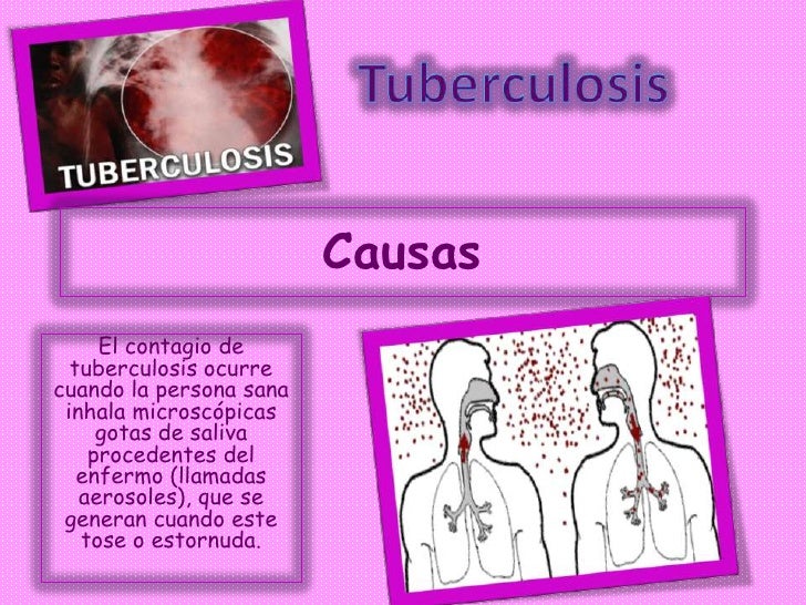 Diapositivas Tuberculosis