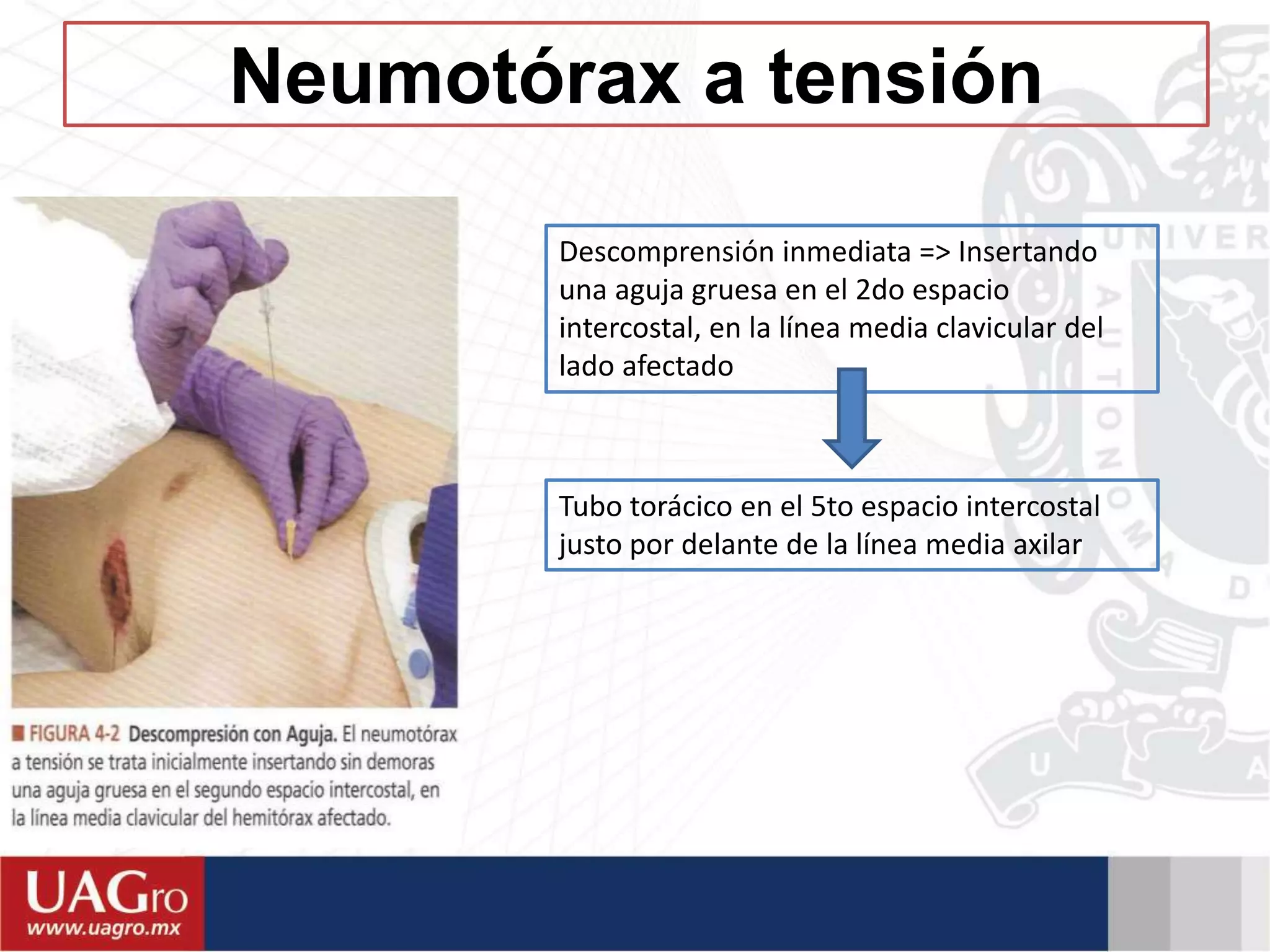 Trauma Torácico | PPTX