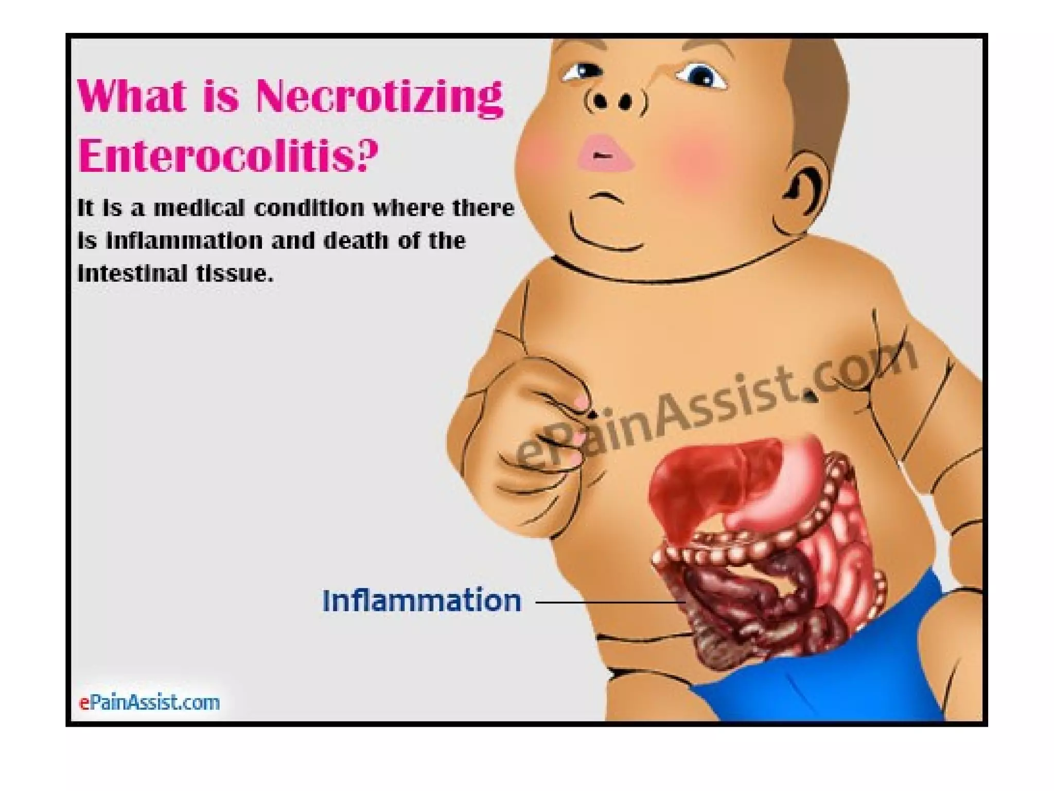 Diarrhea & Enterocolitis | PPT