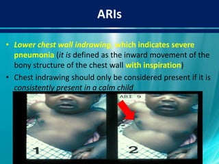 Diarrhoea, ar is & malnutrition dr ajay tyagi | PPTX | Digestive ...