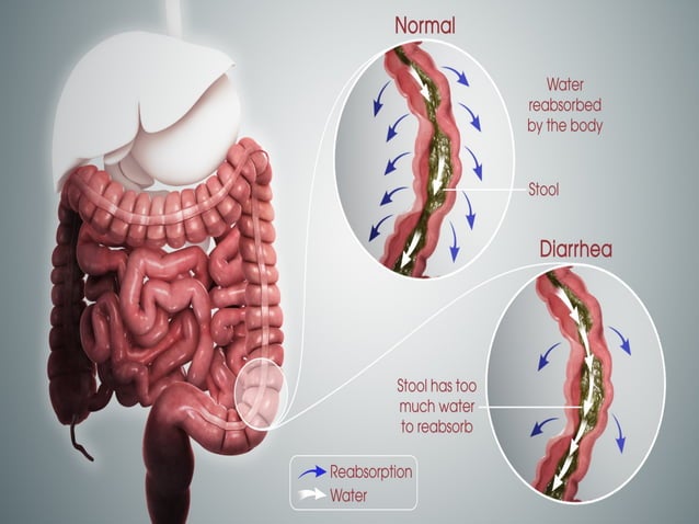 Diarrhoea & Constipation.pptx - causes.. | PPTX