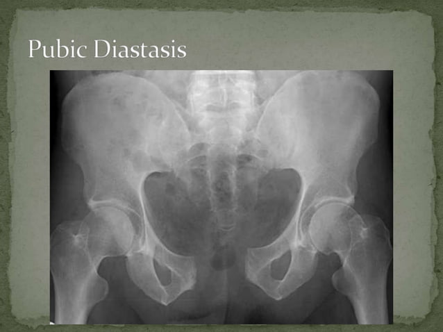 Diastasis | PPT