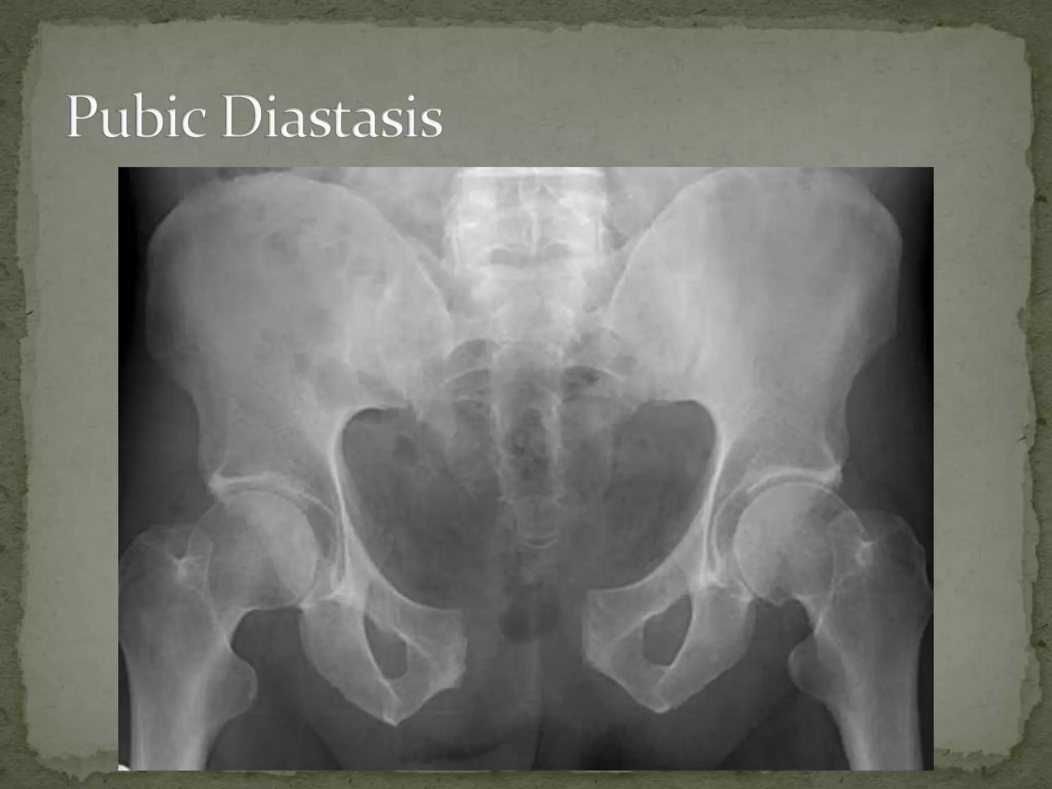 Pubic Diastasis Power Point | PPTX
