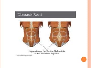 Diastasis Recti.pptx
