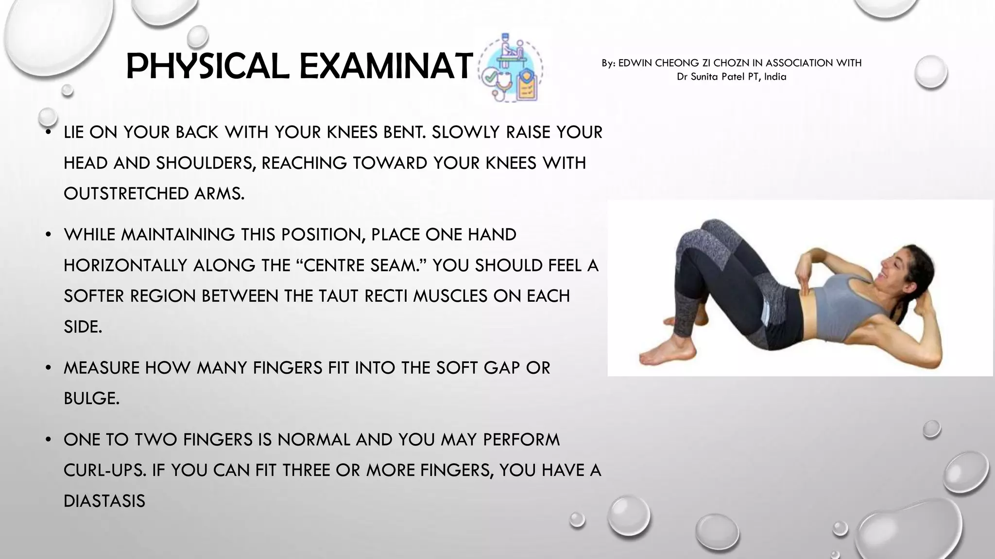 DIASTASIS RECTI - Edwin Cheong Zi Chozn.pdf