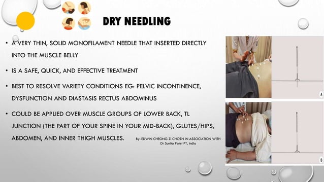 DIASTASIS RECTI - Edwin Cheong Zi Chozn.pdf