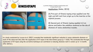 DIASTASIS RECTI - Edwin Cheong Zi Chozn.pdf
