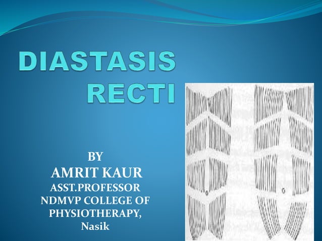 Diastasis recti | PPTX