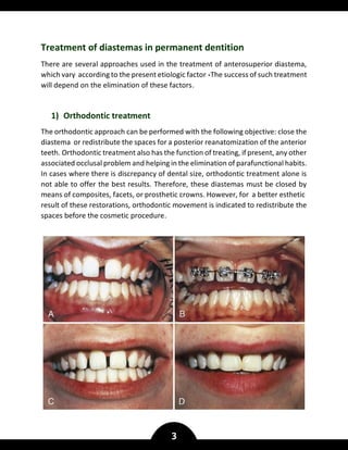 Diastema closure - operative report | PDF