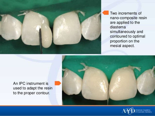 A Step-By-Step Approach to a Diastema Closure