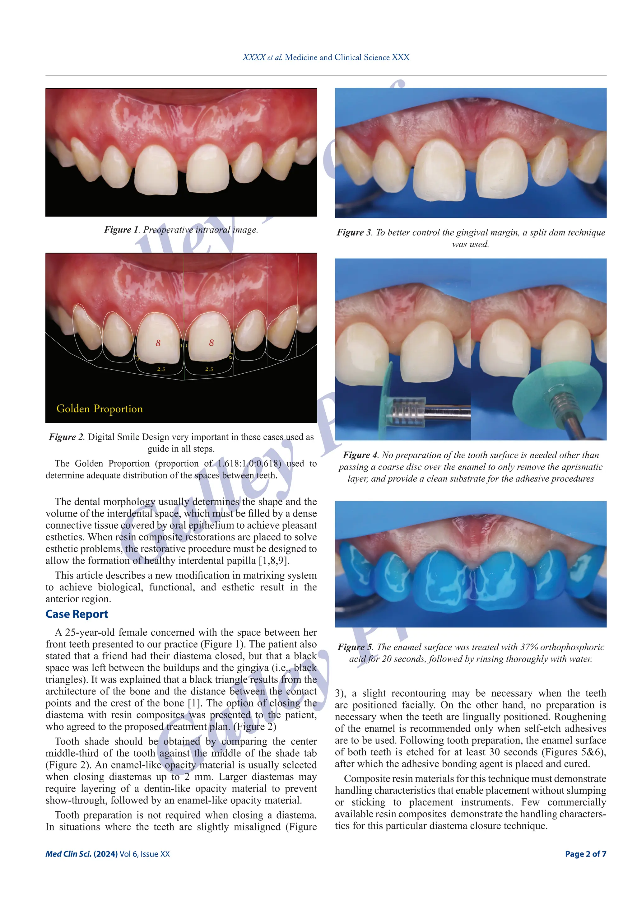 Diastema Closure With Direct Composite.pdf