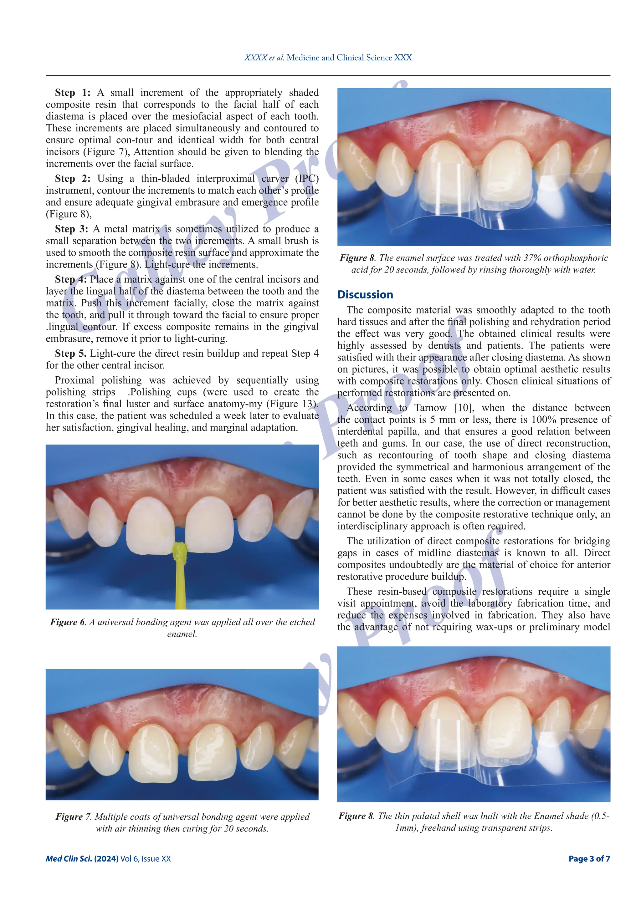 Diastema Closure With Direct Composite.pdf