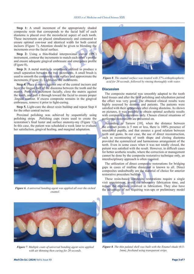 Diastema Closure With Direct Composite.pdf