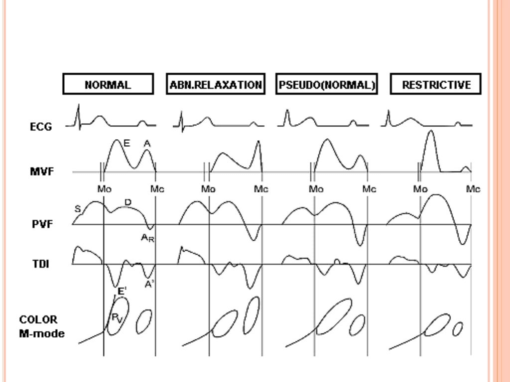 Diastolic Dysfunction 2016
