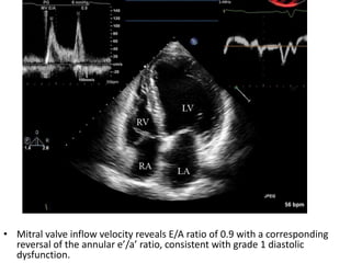 Diastolic dysfunction evaluation | PPTX