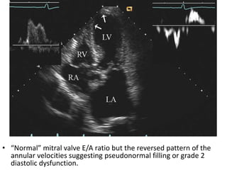Diastolic dysfunction evaluation | PPTX