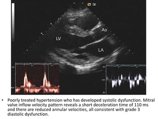 Diastolic dysfunction evaluation | PPTX