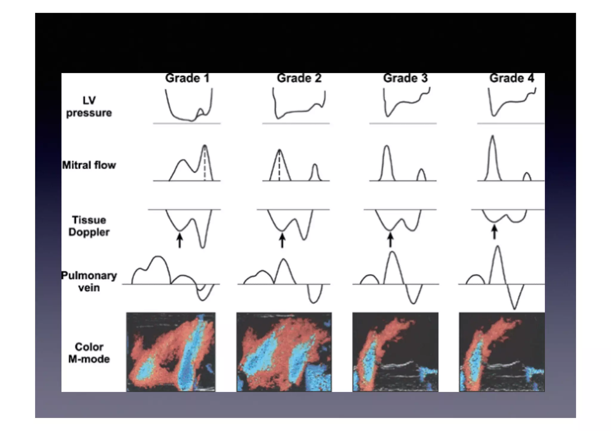 Echocardiographic Evaluation of LV Diastolic Function | PDF