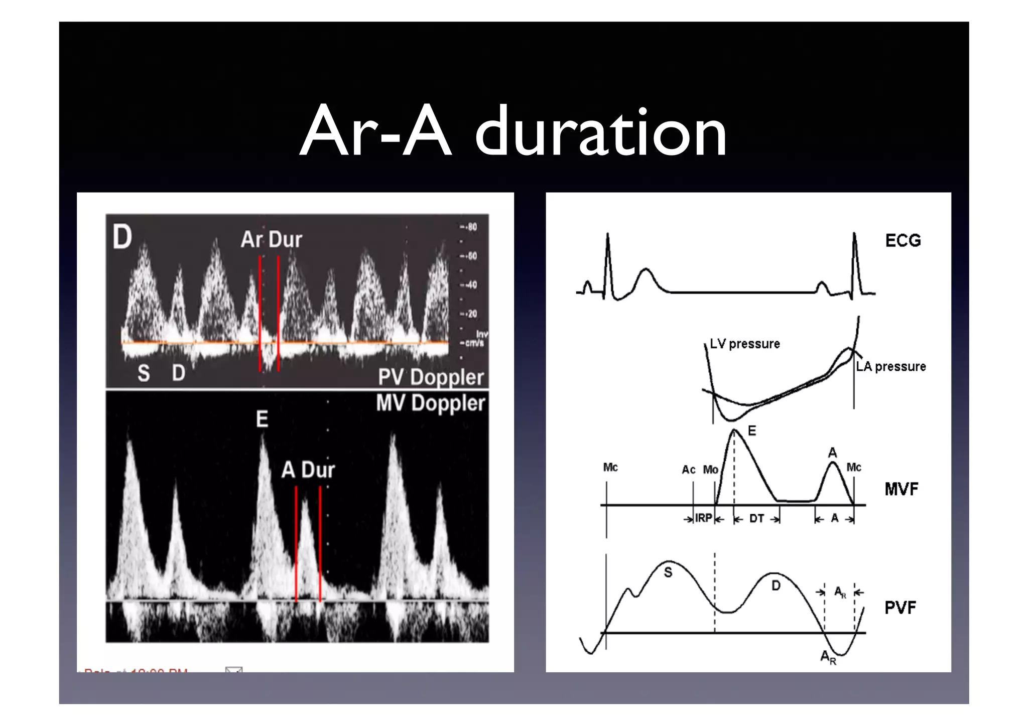 Echocardiographic Evaluation of LV Diastolic Function | PDF