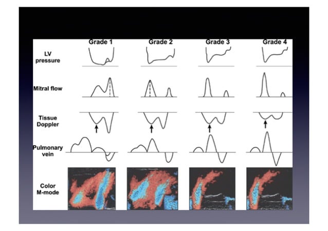Echocardiographic Evaluation of LV Diastolic Function | PDF