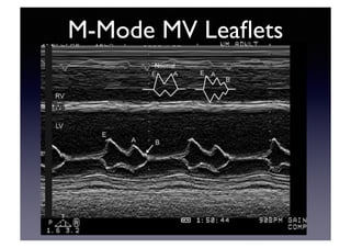 Echocardiographic Evaluation of LV Diastolic Function | PDF