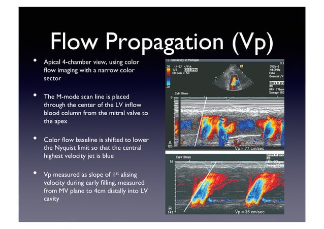 Echocardiographic Evaluation Of Lv Diastolic Function