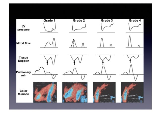 Echocardiographic Evaluation Of Lv Diastolic Function